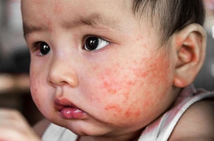 Dermatite atópica em bebê: o que é, causas e tratamento